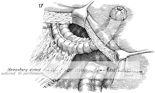 Chuyên đề tuần 5 – Open Hartmann’s procedure – Trần Bá Lộc – Y2013B ...